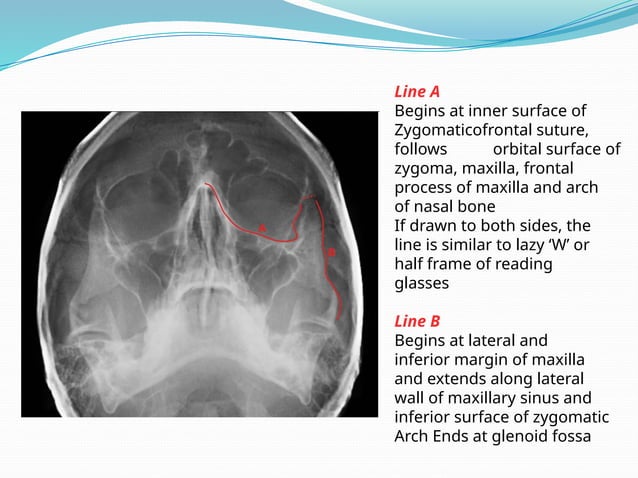 maxilla anatomy development surgical anatomy.pptx