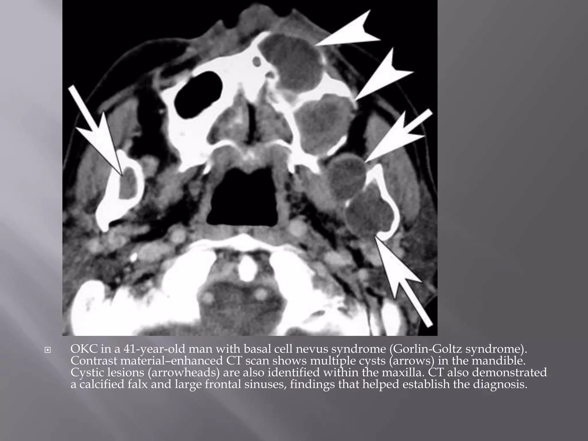 Maxilla and mandible – benign & malignant tumours | PPTX