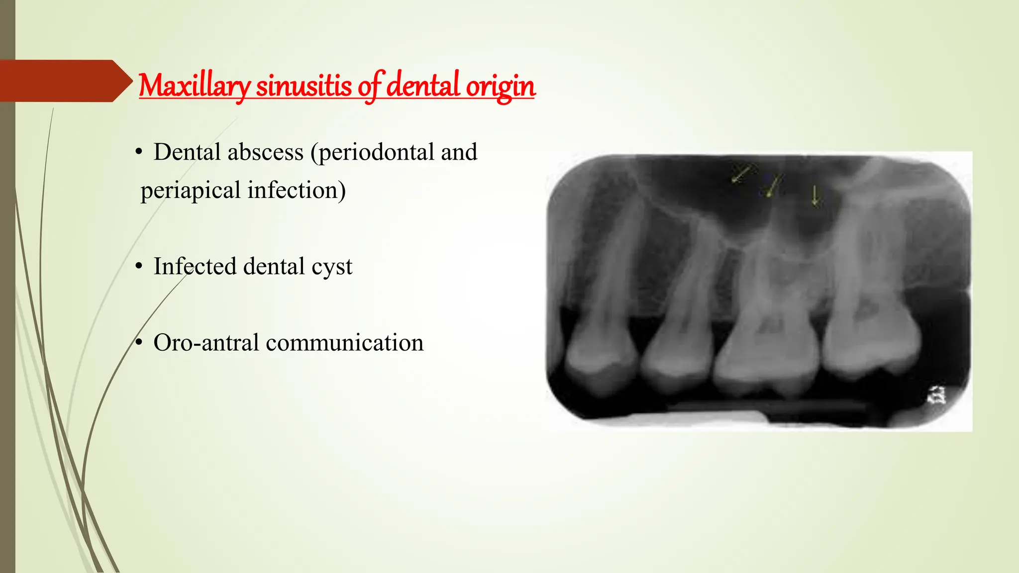 SURGICAL AND APPLIED ANATOMY OF MAXILLA. | PPTX