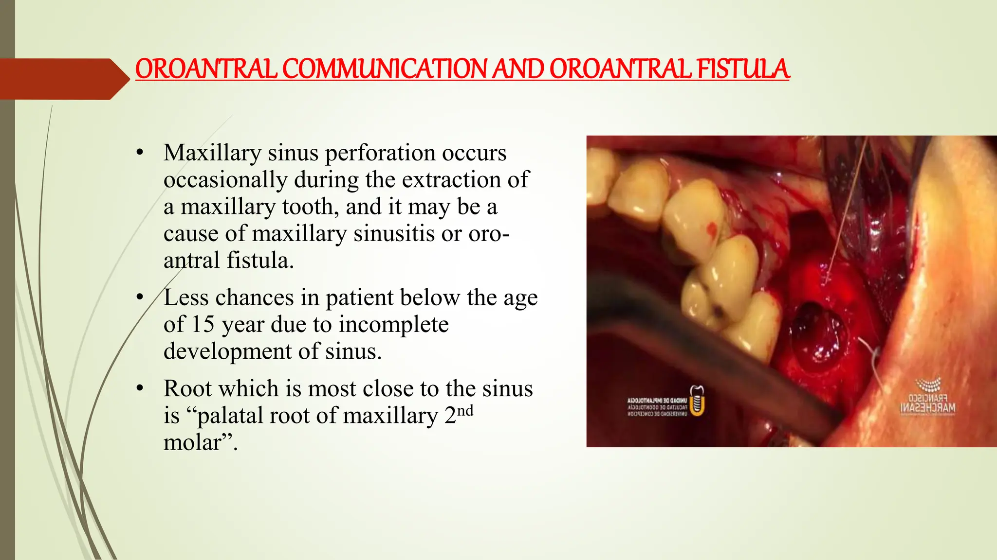 SURGICAL AND APPLIED ANATOMY OF MAXILLA. | PPTX