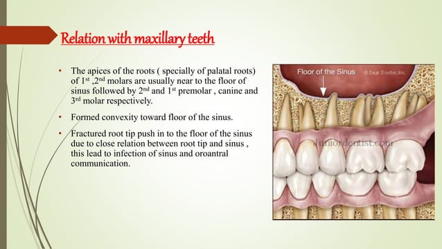 SURGICAL AND APPLIED ANATOMY OF MAXILLA. | PPTX