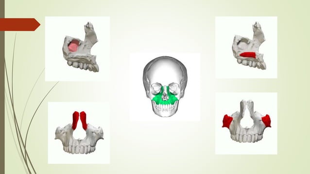 SURGICAL AND APPLIED ANATOMY OF MAXILLA. | PPTX