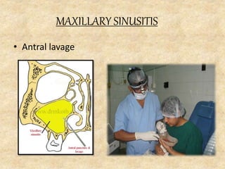 Maxillary sinus for dental students year 1 | PPTX