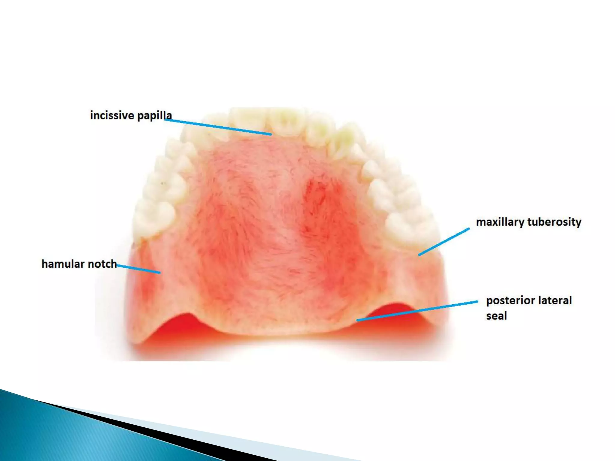 Maxillary denture-landmarks | PPTX