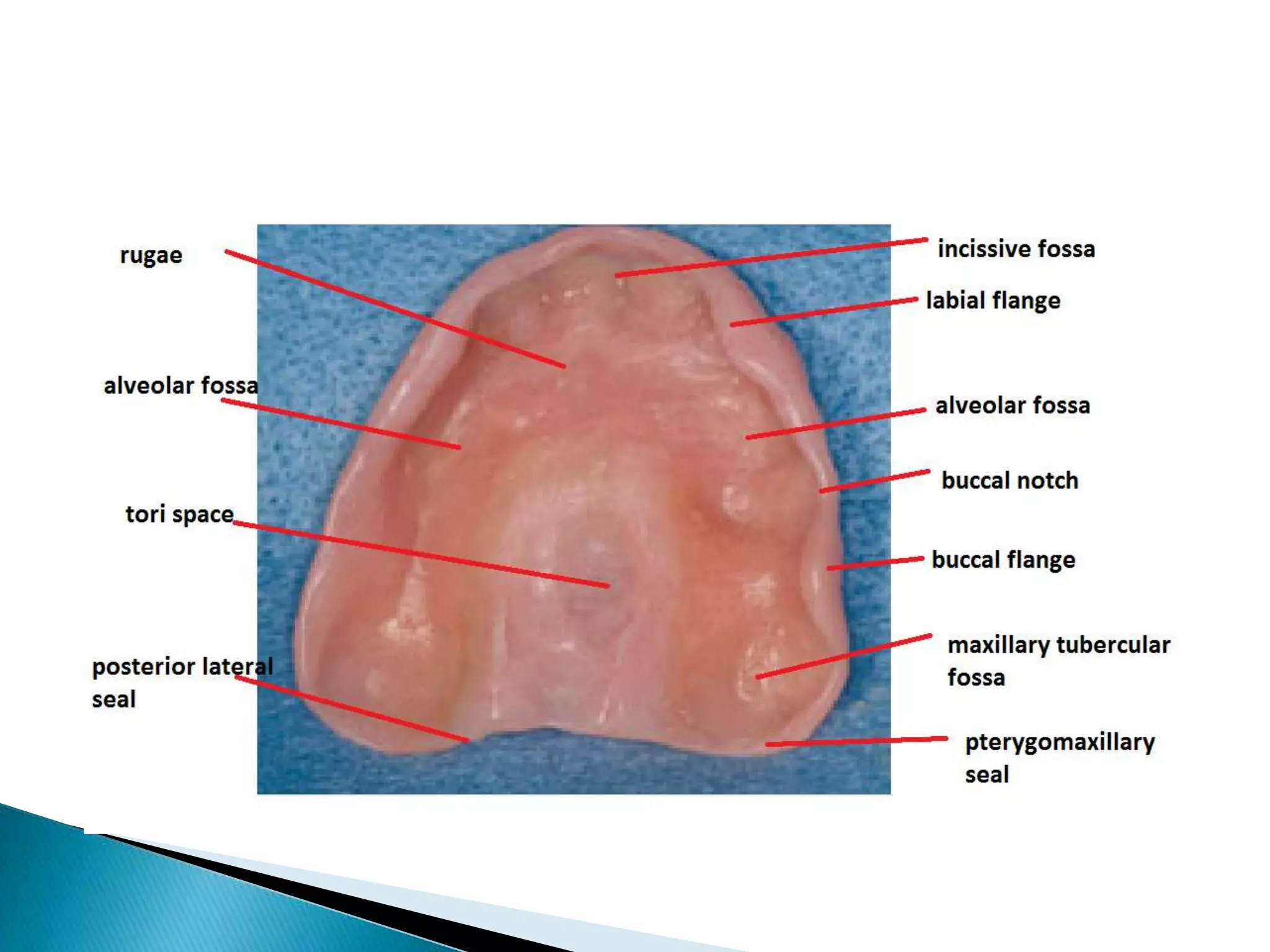 Maxillary denture-landmarks | PPTX