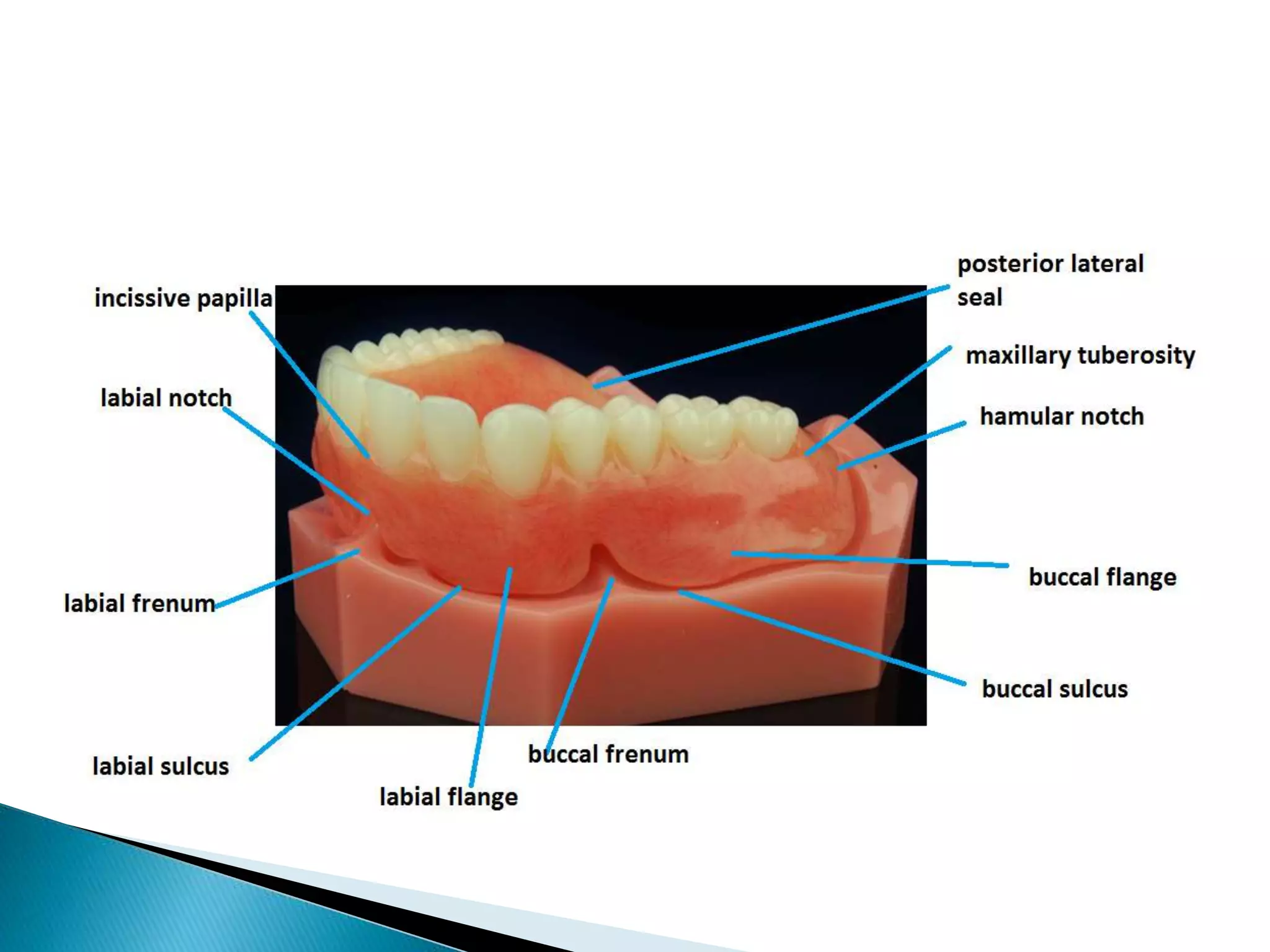 Maxillary denture-landmarks | PPTX
