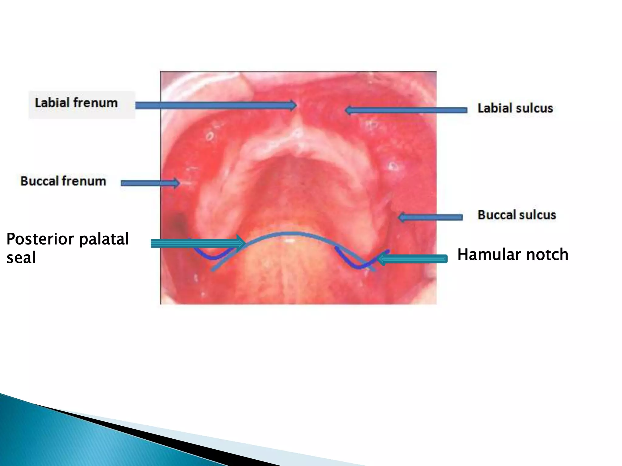 Maxillary denture-landmarks | PPTX