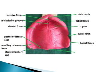 Maxillary denture-landmarks | PPTX
