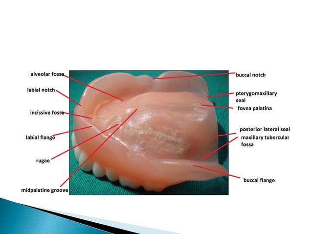Maxillary denture-landmarks | PPTX