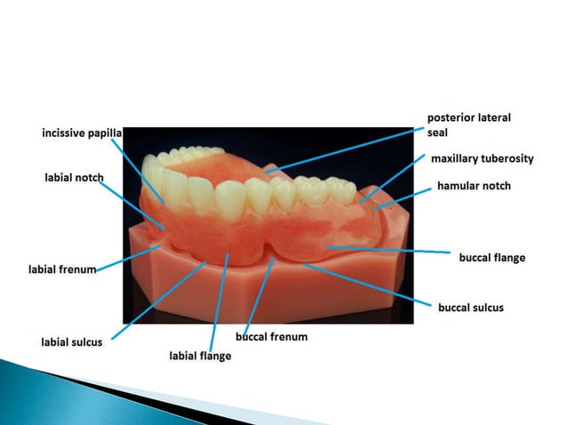 Maxillary denture-landmarks | PPTX
