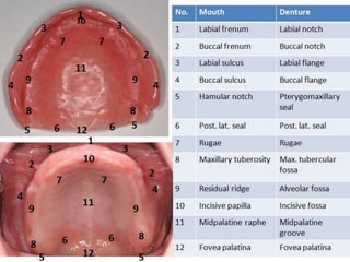 Maxillary denture-landmarks | PPTX