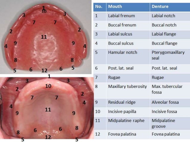 Maxillary denture-landmarks | PPTX