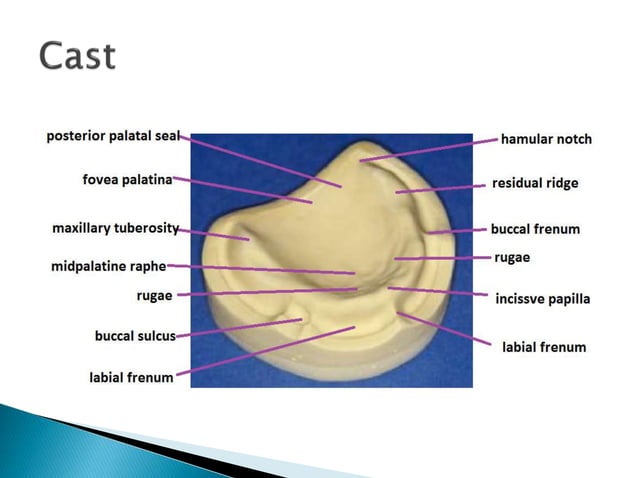 Maxillary denture-landmarks | PPT
