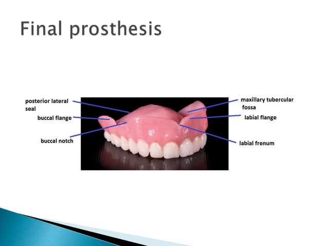 Maxillary denture-landmarks | PPT