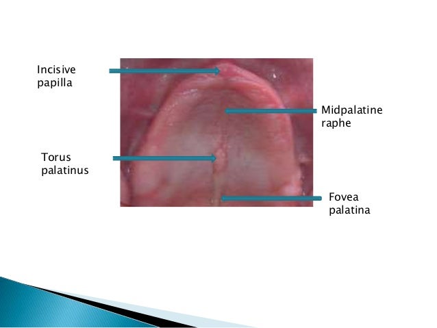 Maxillary denture-landmarks