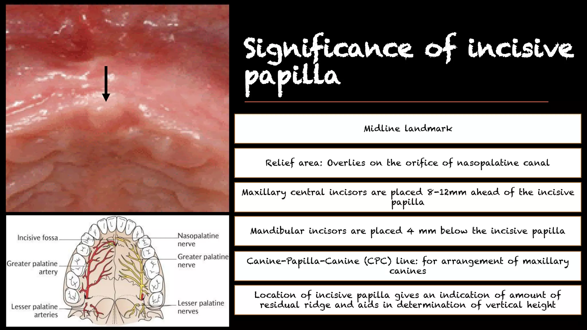 ANATOMICAL LANDMARKS OF EDENTULOUS MAXILLA | PDF