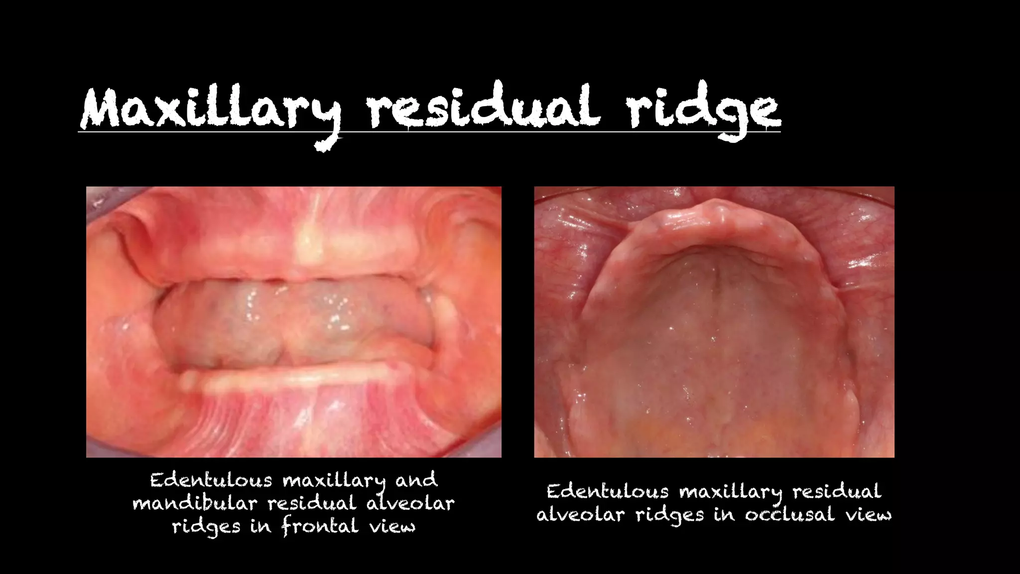 ANATOMICAL LANDMARKS OF EDENTULOUS MAXILLA | PDF