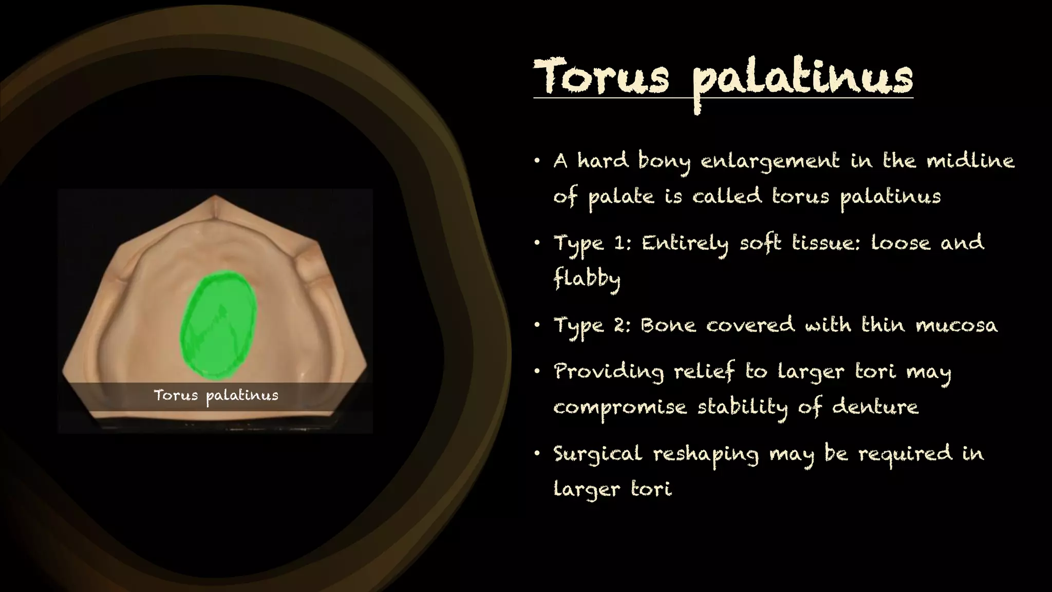ANATOMICAL LANDMARKS OF EDENTULOUS MAXILLA | PDF