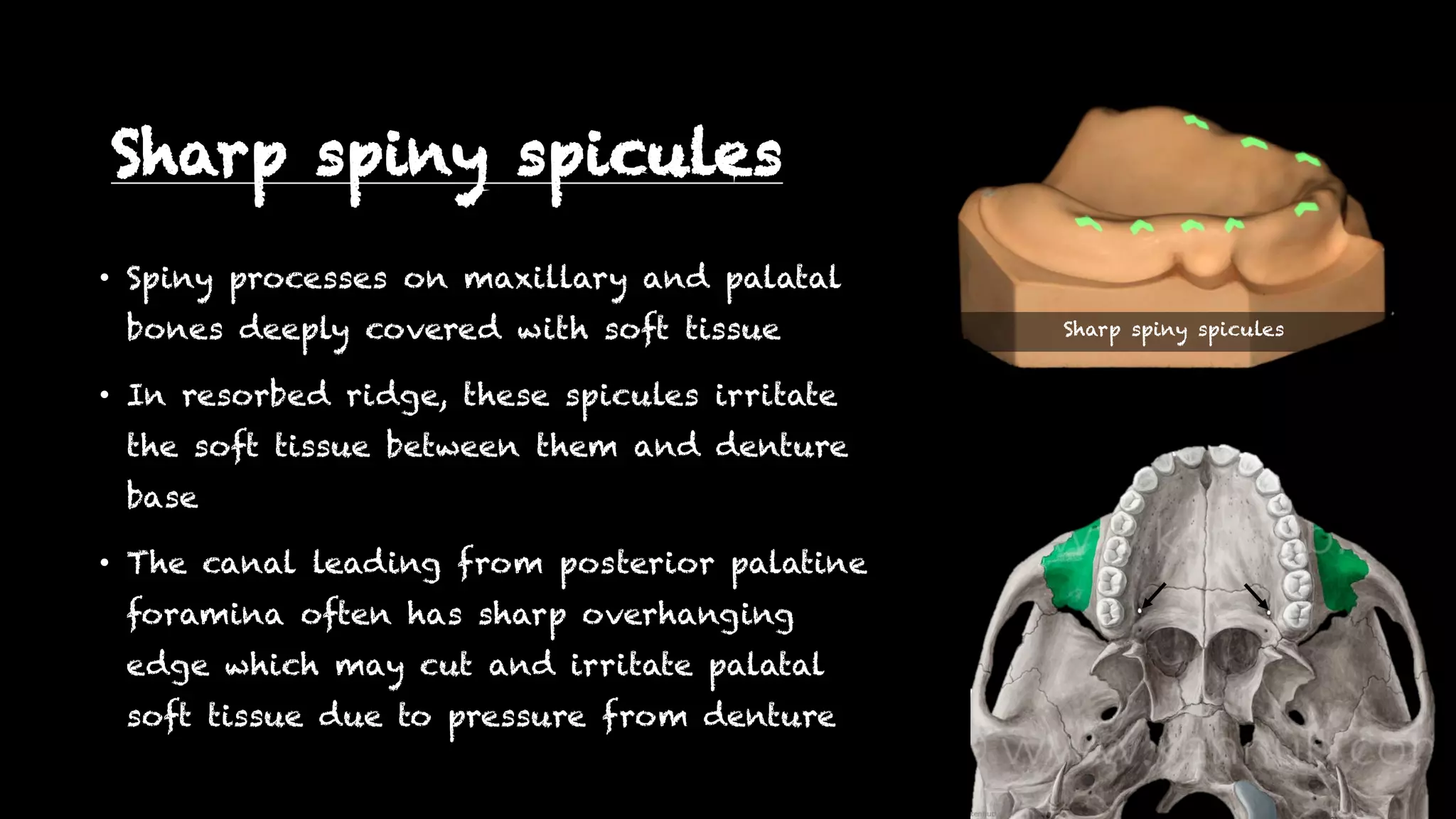 ANATOMICAL LANDMARKS OF EDENTULOUS MAXILLA | PDF