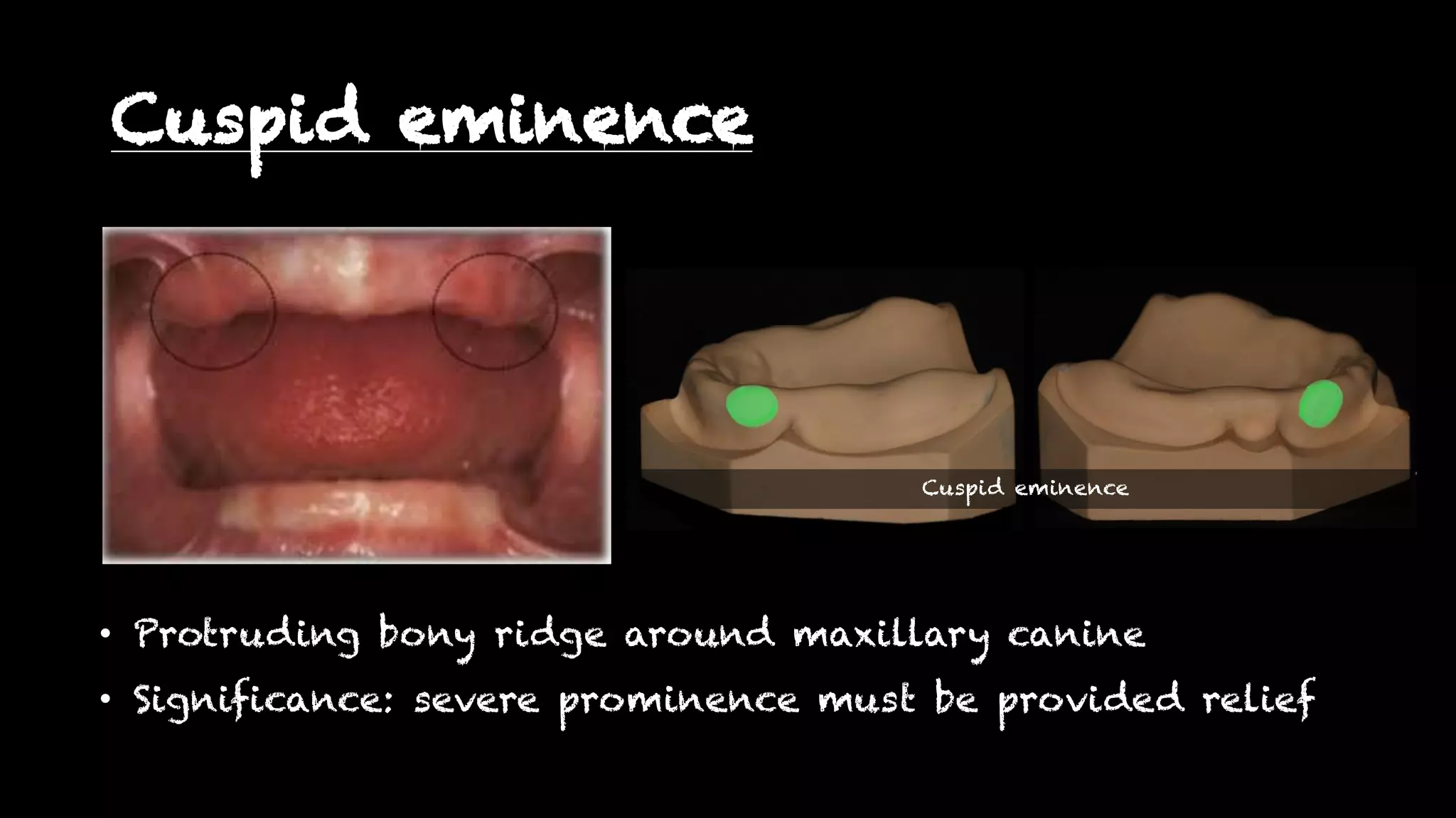 ANATOMICAL LANDMARKS OF EDENTULOUS MAXILLA | PDF