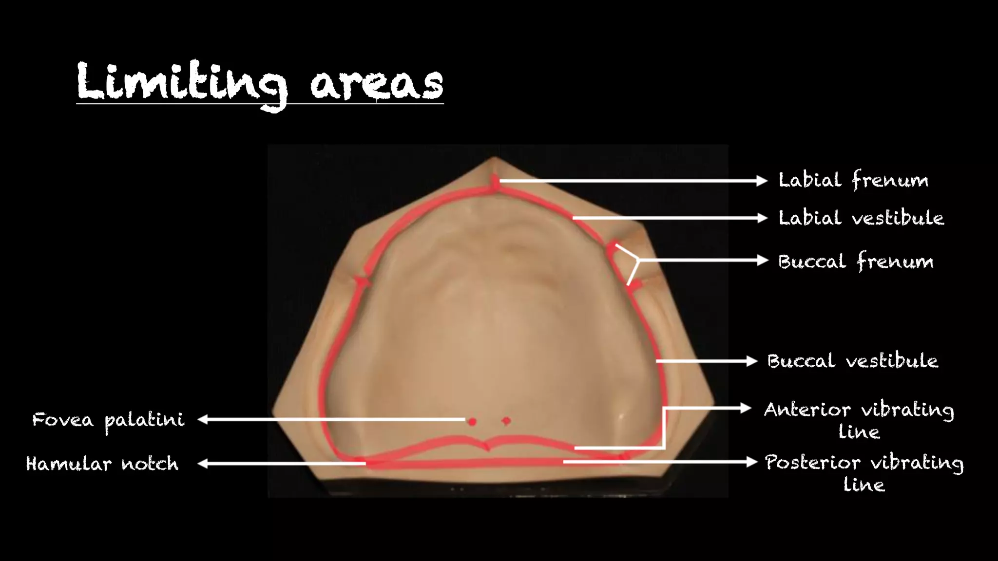 ANATOMICAL LANDMARKS OF EDENTULOUS MAXILLA | PDF