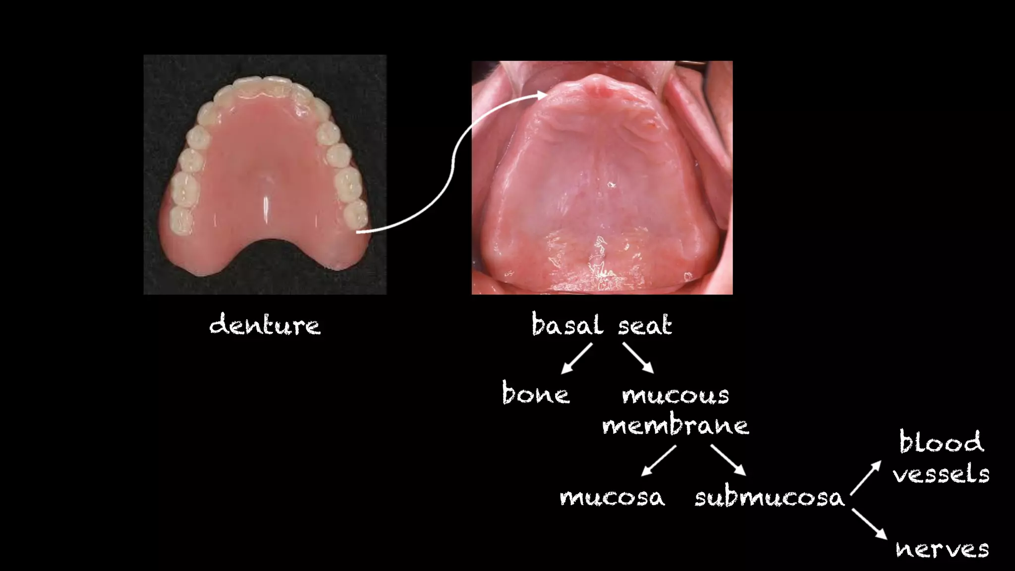 ANATOMICAL LANDMARKS OF EDENTULOUS MAXILLA | PDF