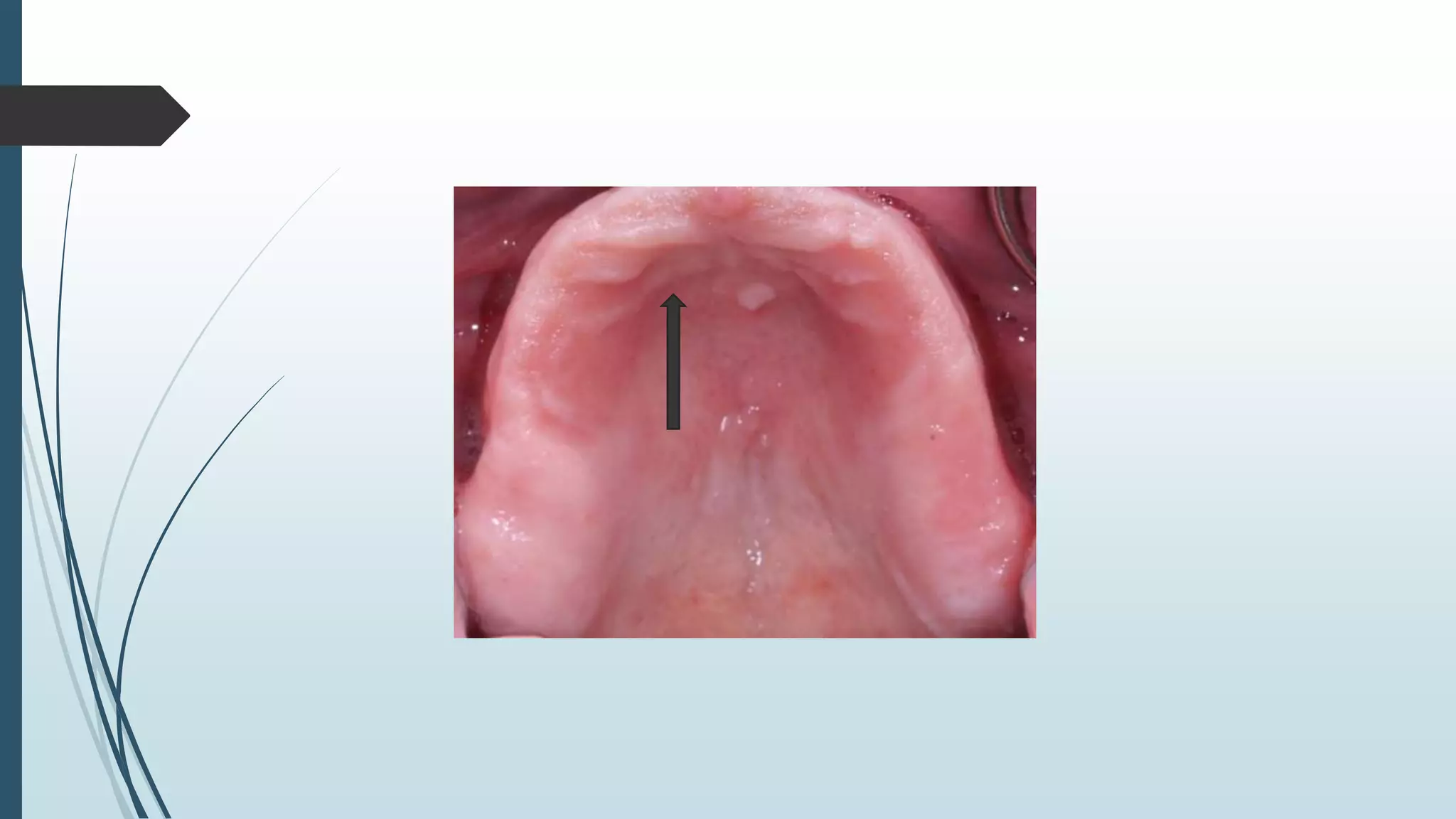 MAXILLARY ANATOMICAL LANDMARKS.pptx