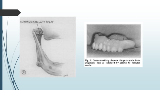 MAXILLARY ANATOMICAL LANDMARKS.pptx