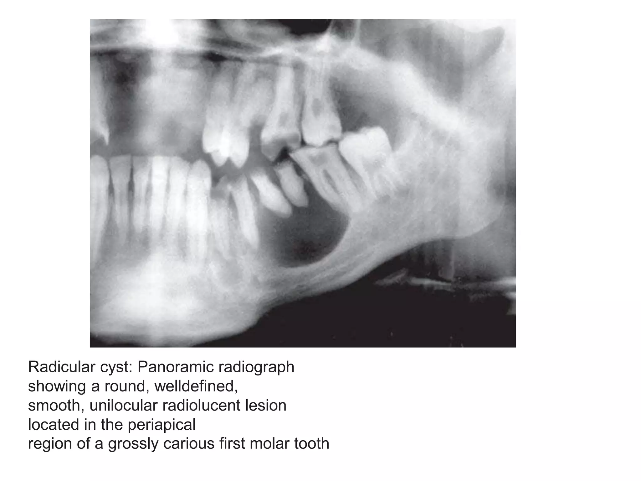 Maxillary and jaw lesions | PPTX