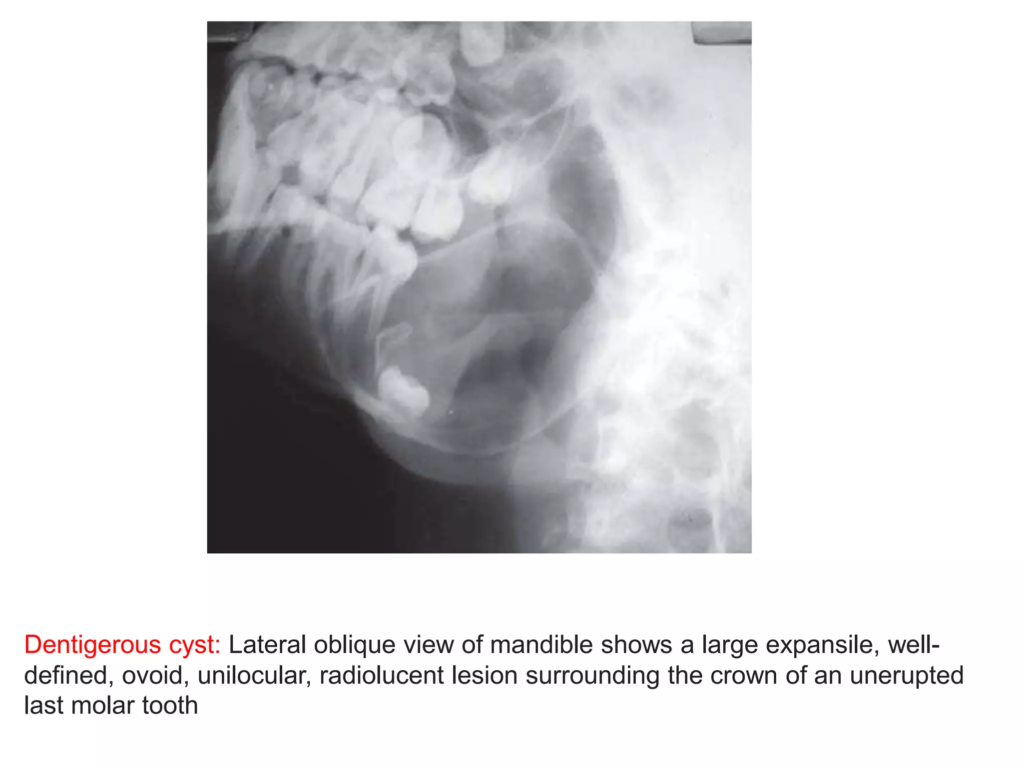 Maxillary and jaw lesions | PPTX