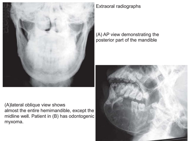 Maxillary and jaw lesions | PPTX | Dental Health | Diseases and Conditions