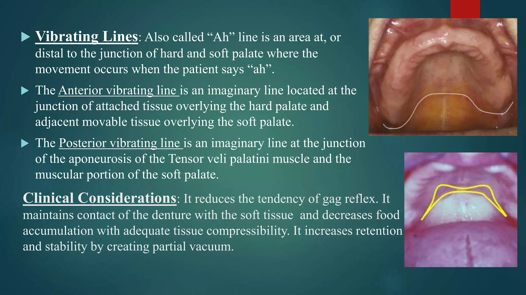Maxillary and mandbular anatomical landmarks | PPTX | Dental Health ...