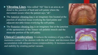 Fovea Palatini Vibrating Line