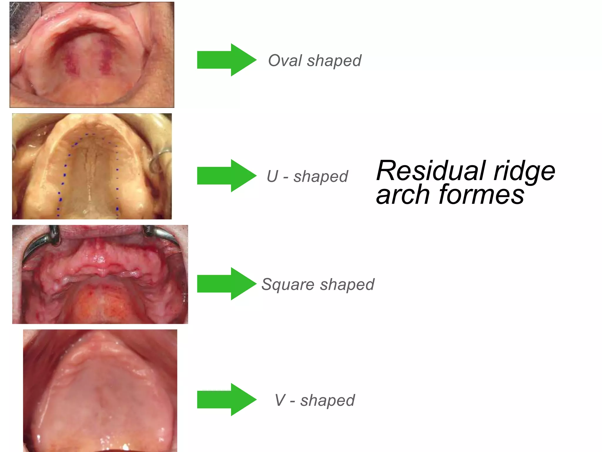 Maxillary and mandibular anatomical land marks | PPTX