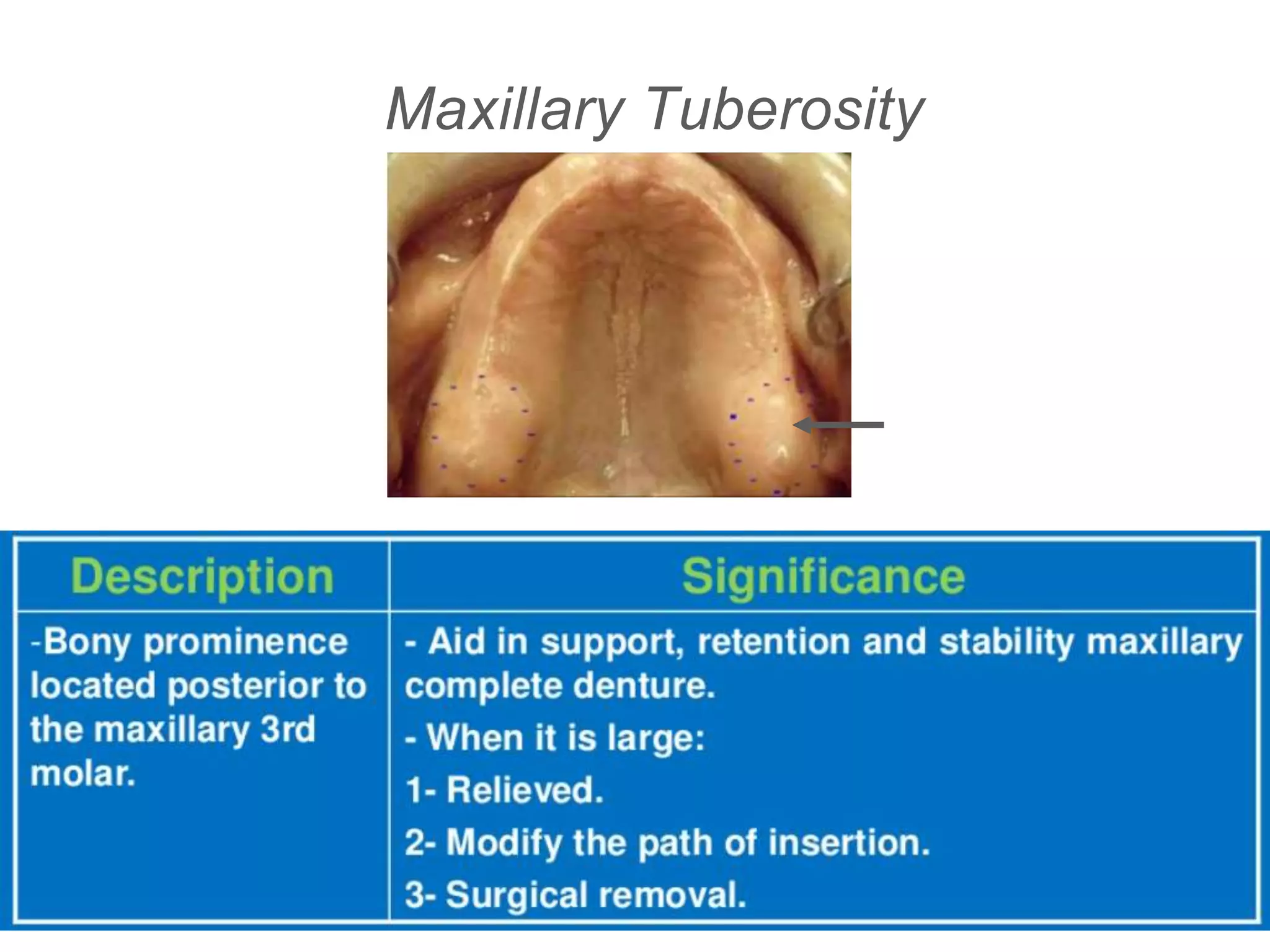 Maxillary and mandibular anatomical land marks | PPTX