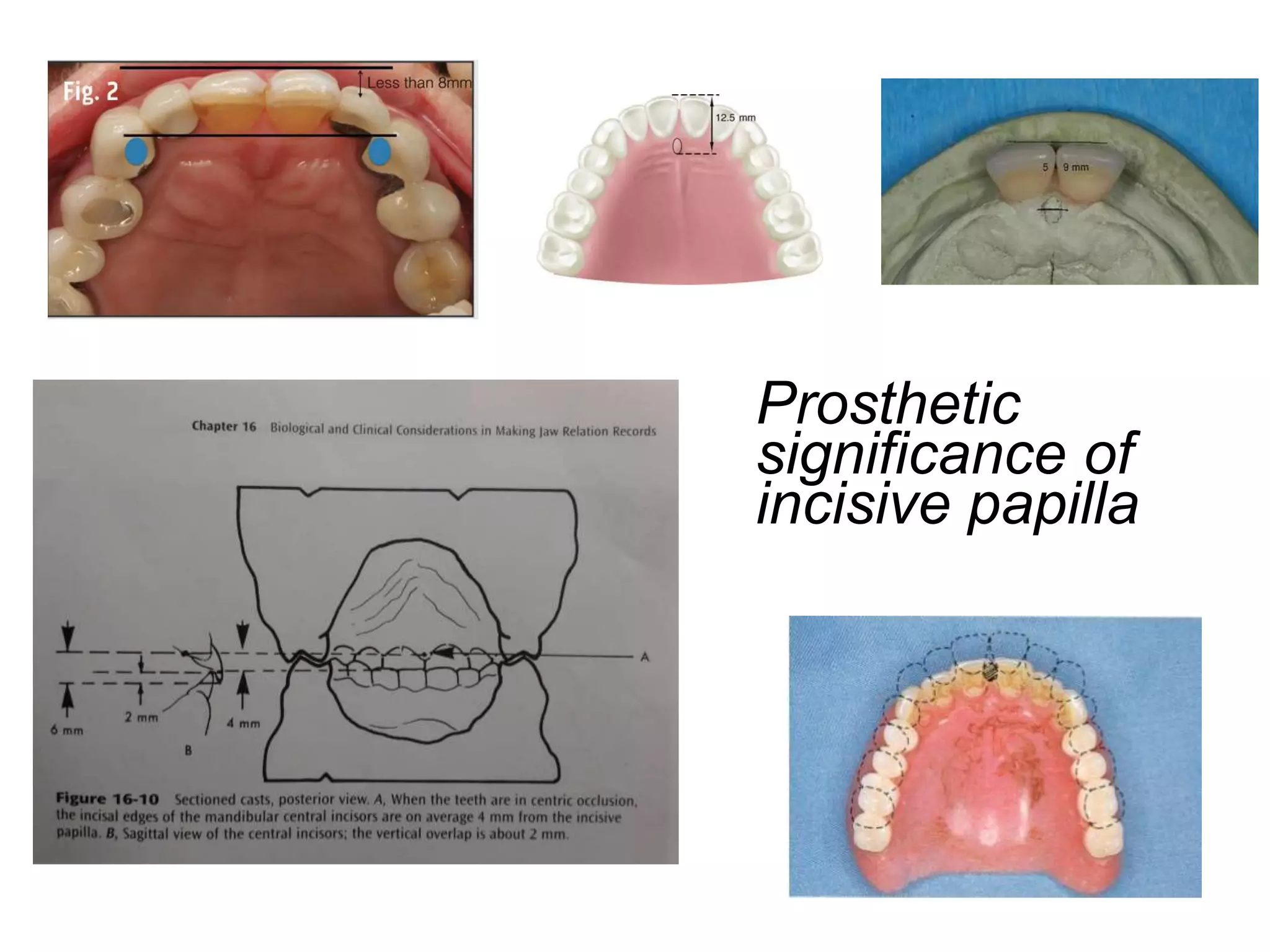 Maxillary and mandibular anatomical land marks | PPTX