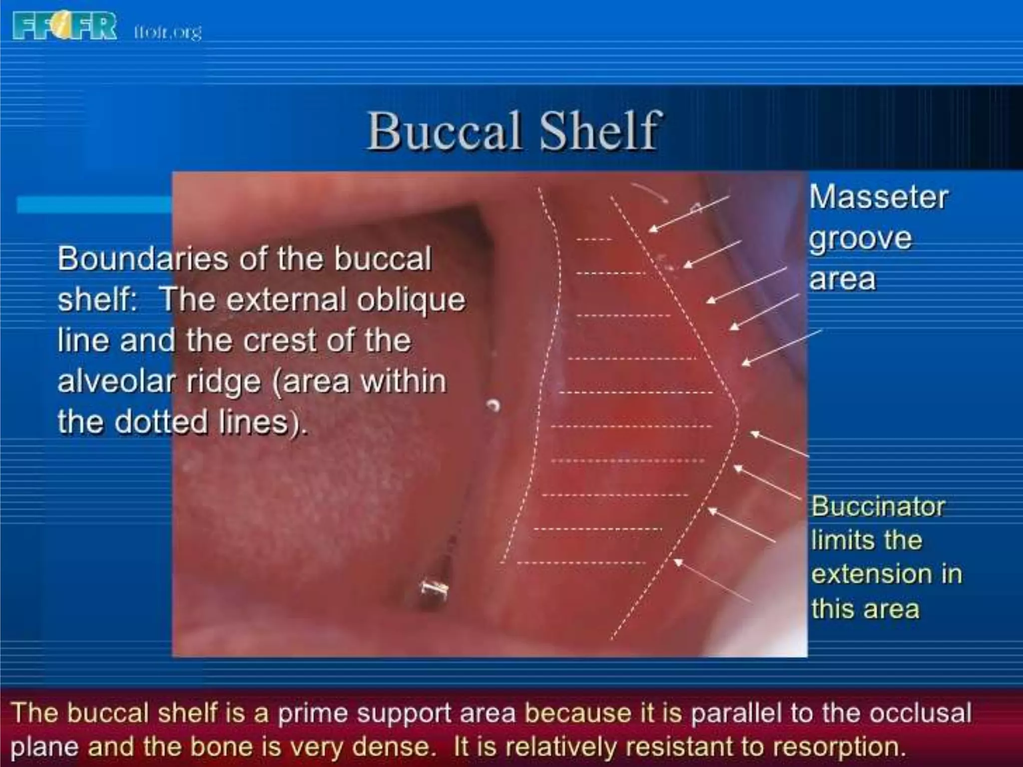 Maxillary and mandibular anatomical land marks | PPTX