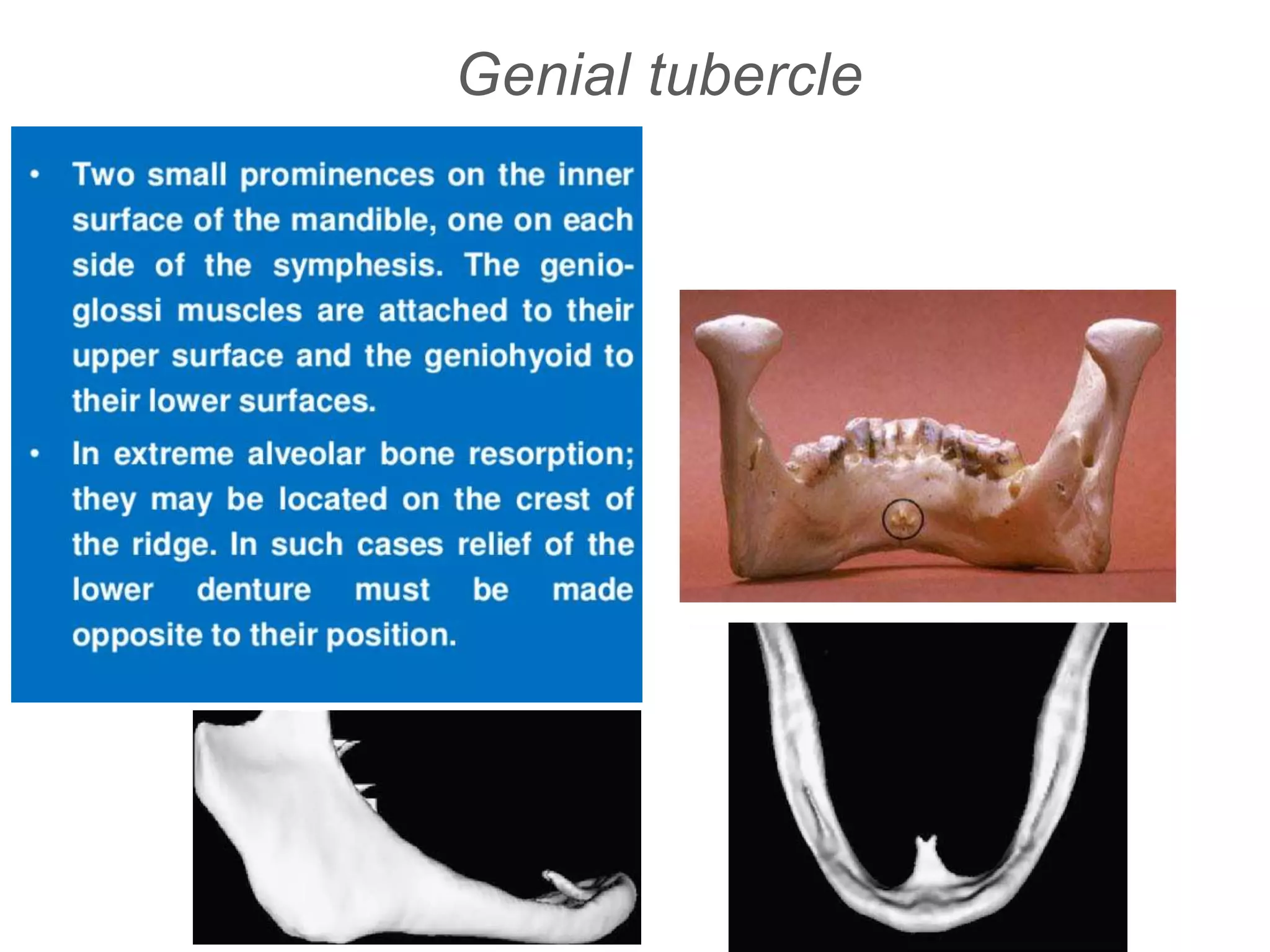 Maxillary and mandibular anatomical land marks | PPTX