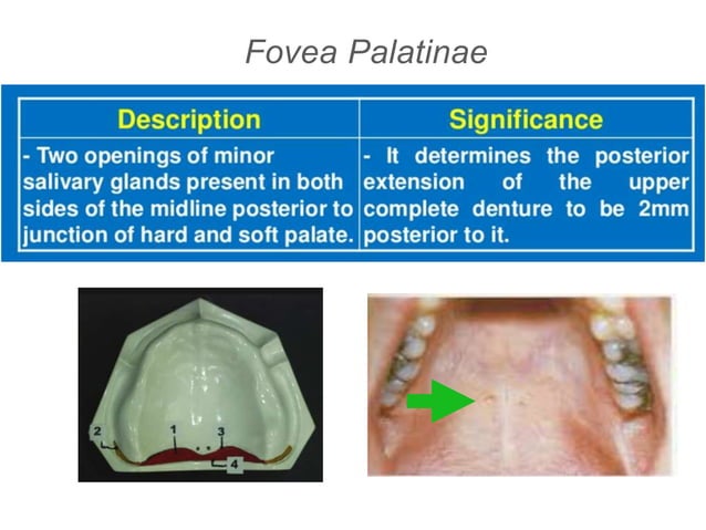 Maxillary and mandibular anatomical land marks | PPTX