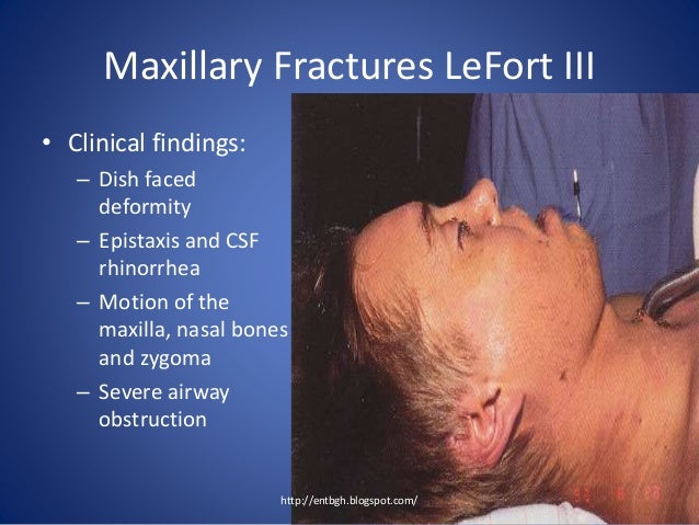 Maxillary and periorbital fractures