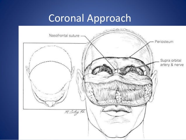Maxillary and periorbital fractures