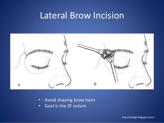 Maxillary and periorbital fractures