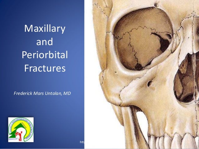 Maxillary and periorbital fractures