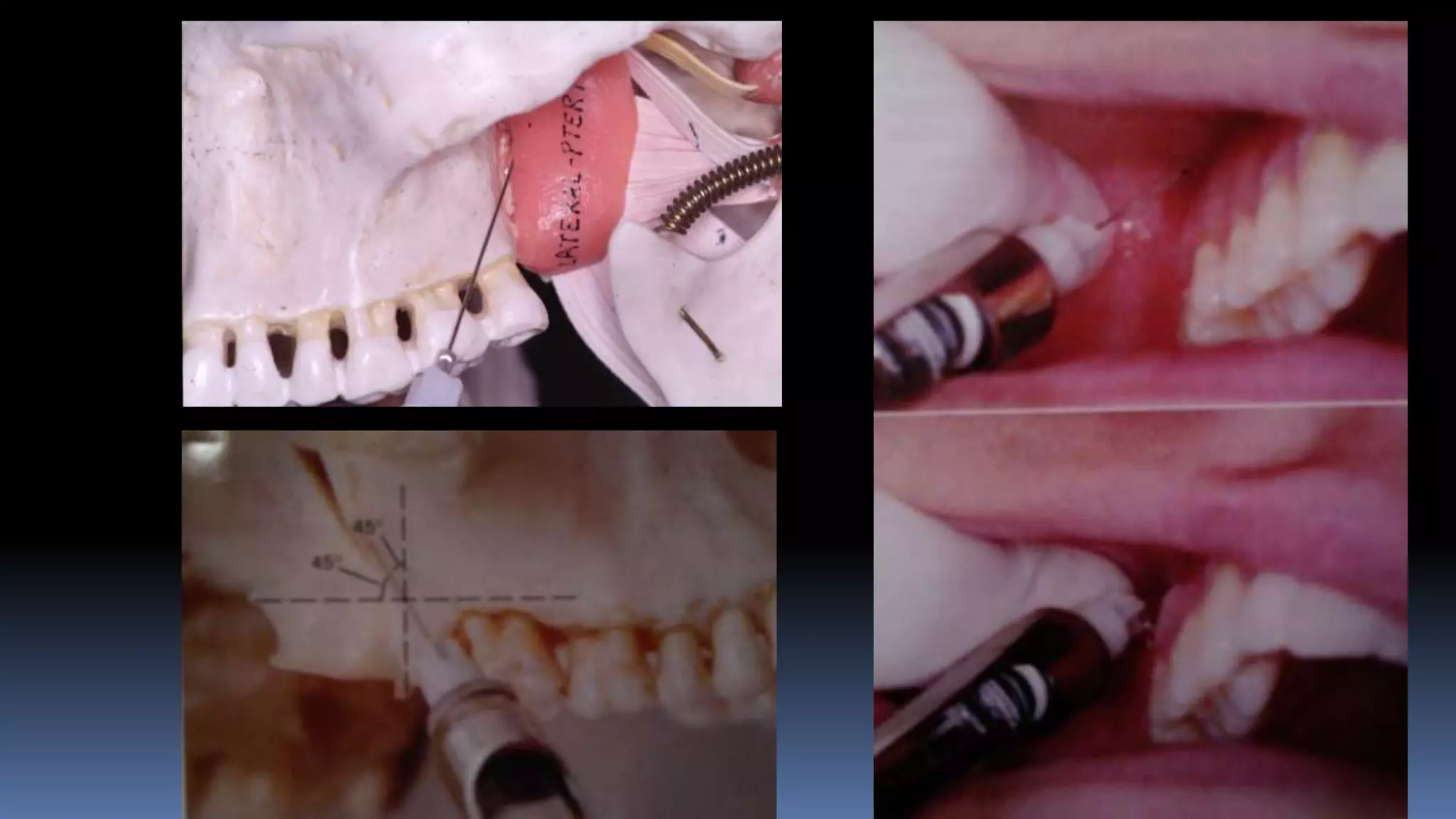 Maxillary anesthesia: its technique | PPTX