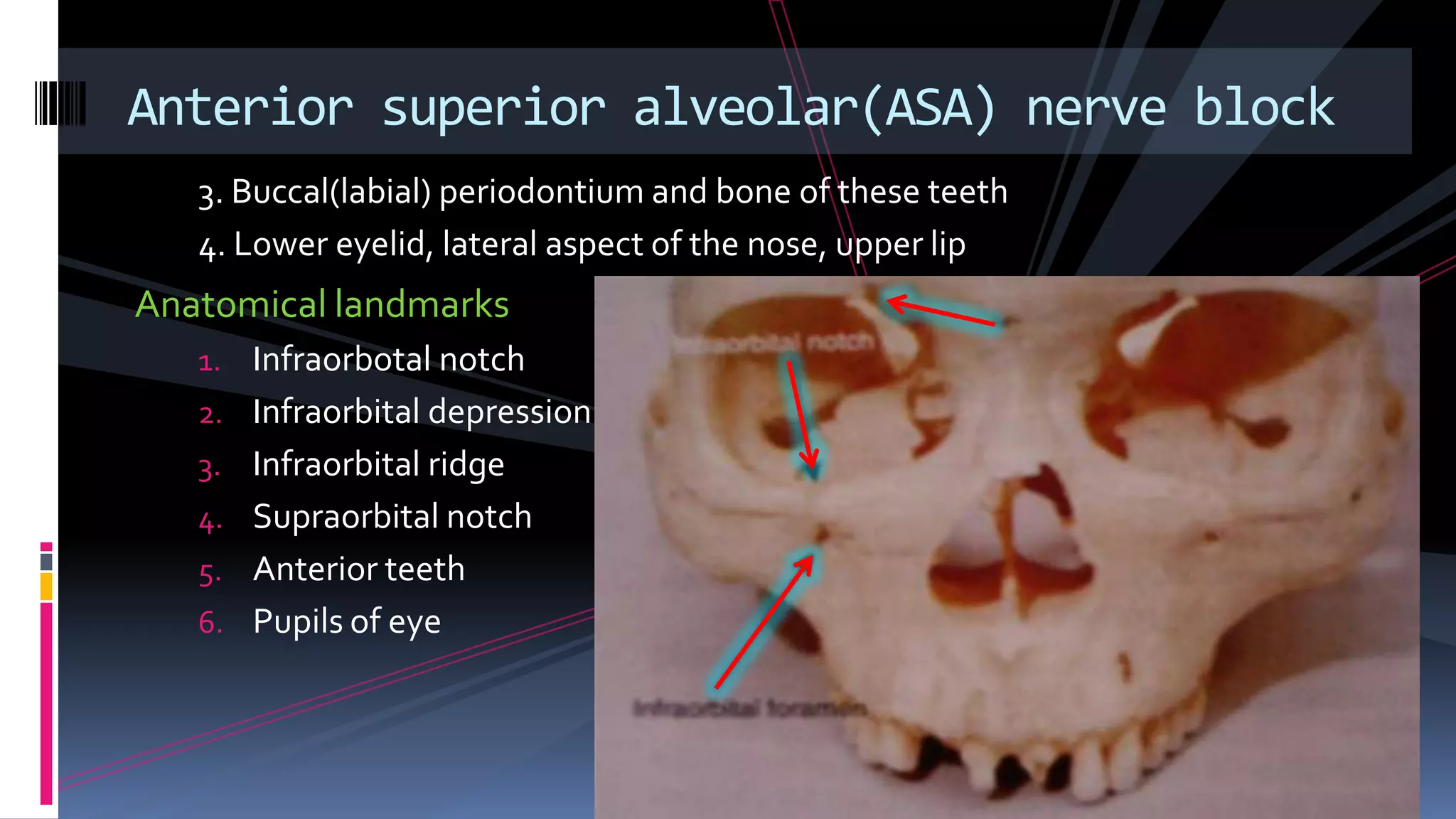 Maxillary anesthesia: its technique | PPTX