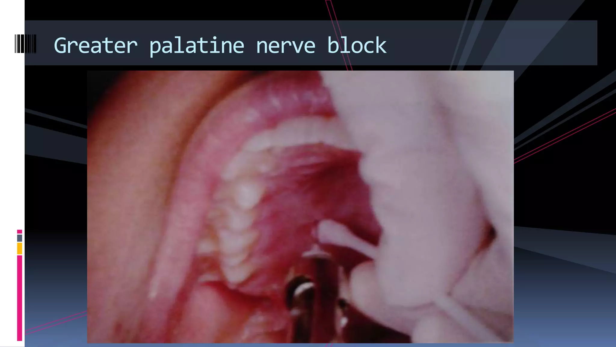 Maxillary anesthesia: its technique | PPTX