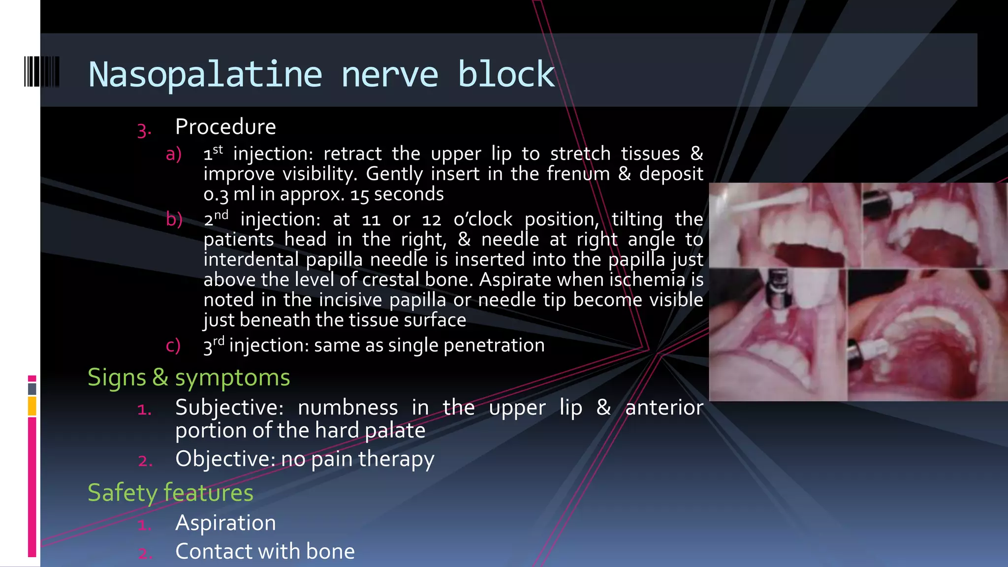 Maxillary anesthesia: its technique | PPTX