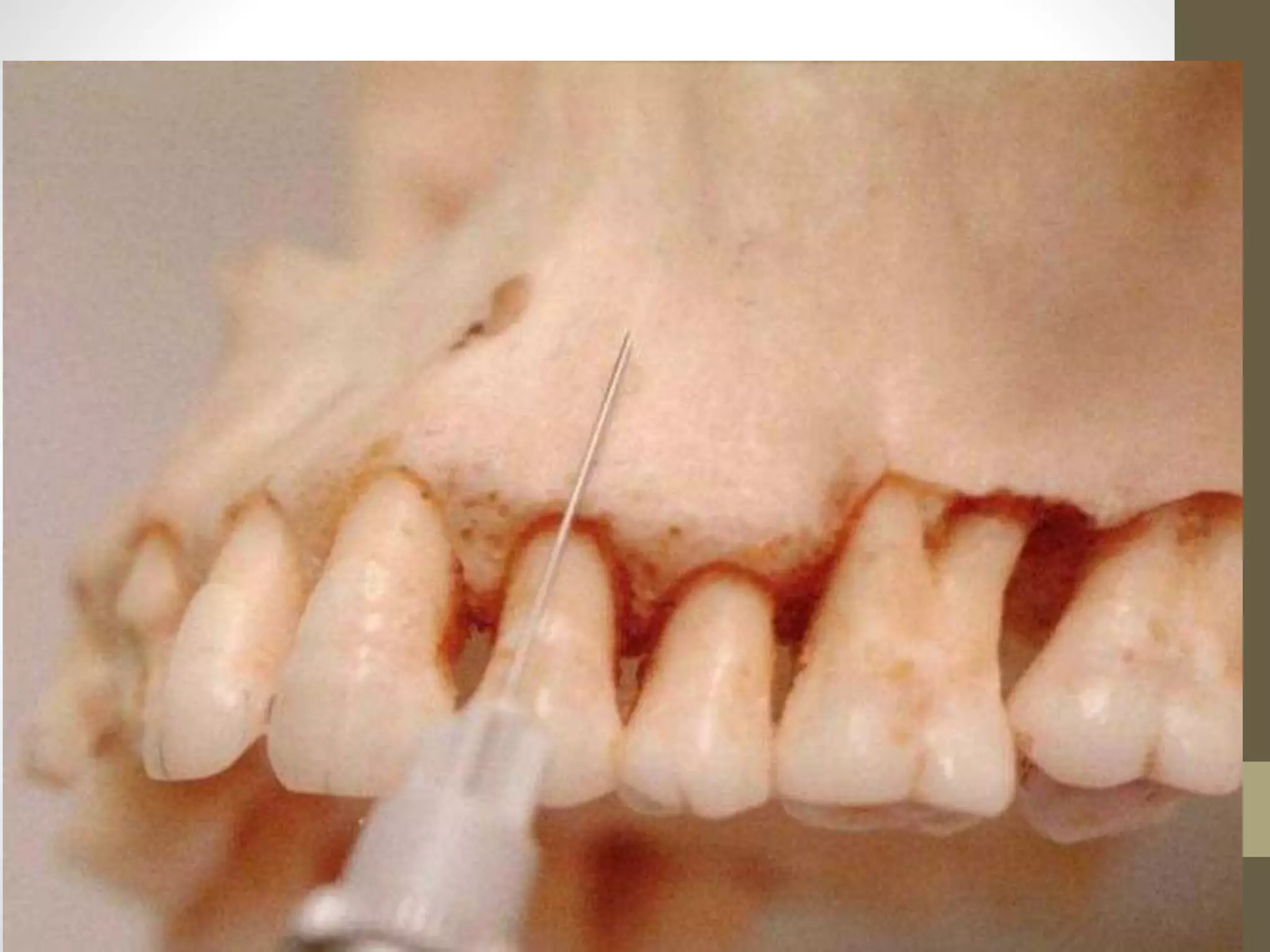 Maxillary anesthesia | PPTX
