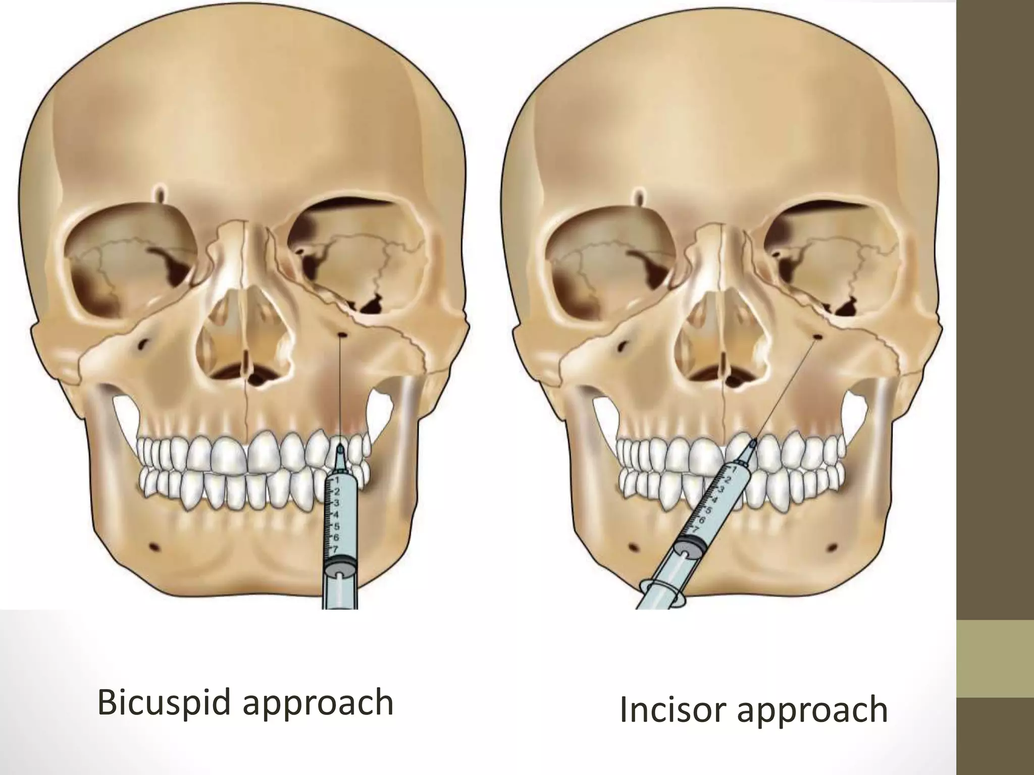 Maxillary anesthesia | PPTX | Ear, Nose and Throat Conditions ...