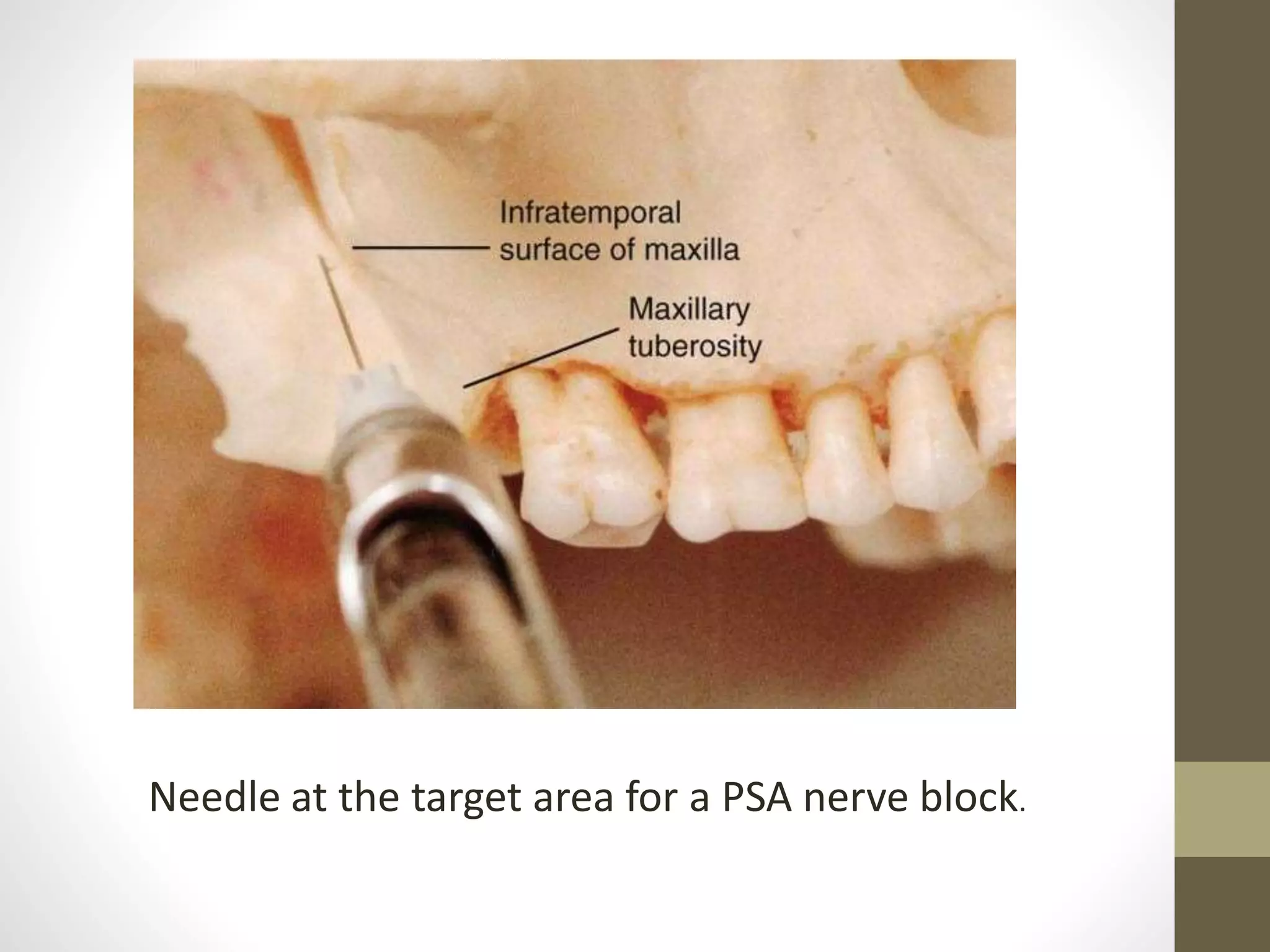 Maxillary anesthesia | PPTX